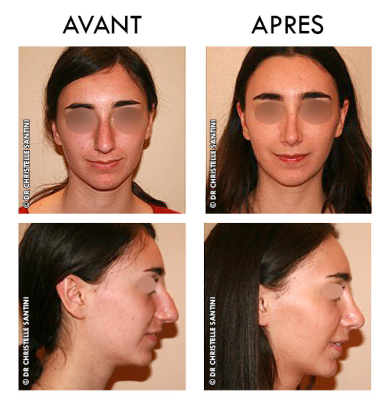 Nose Surgery - Rhinoplasty | Dr Santini
